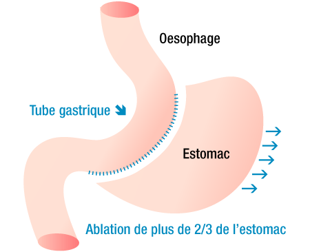 Sleeve Tunisie : operation reduction estomac